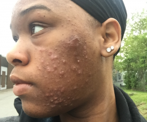 'Skin positivity’ confronts acne stigma - WHYY