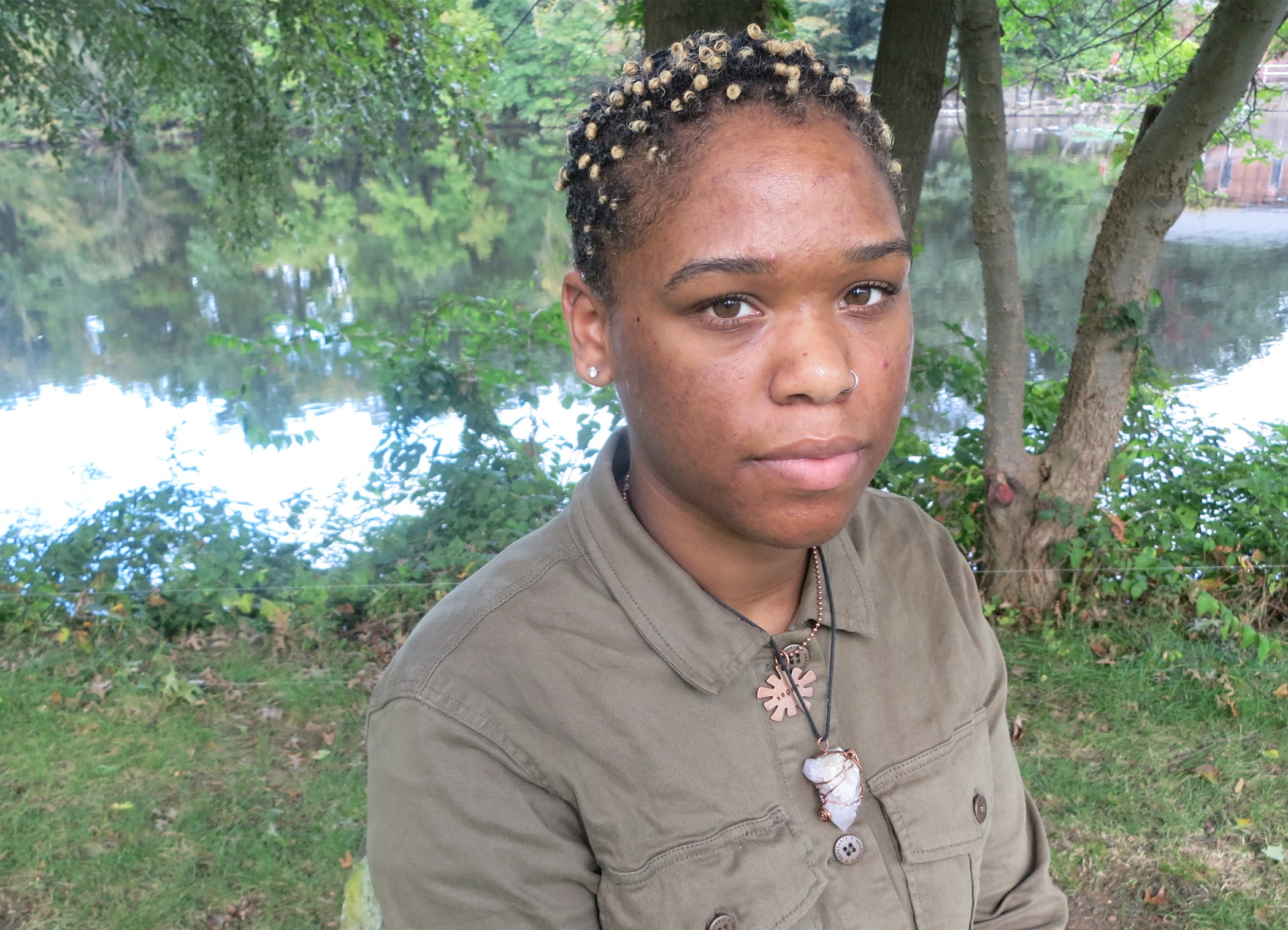 'Skin positivity’ confronts acne stigma - WHYY