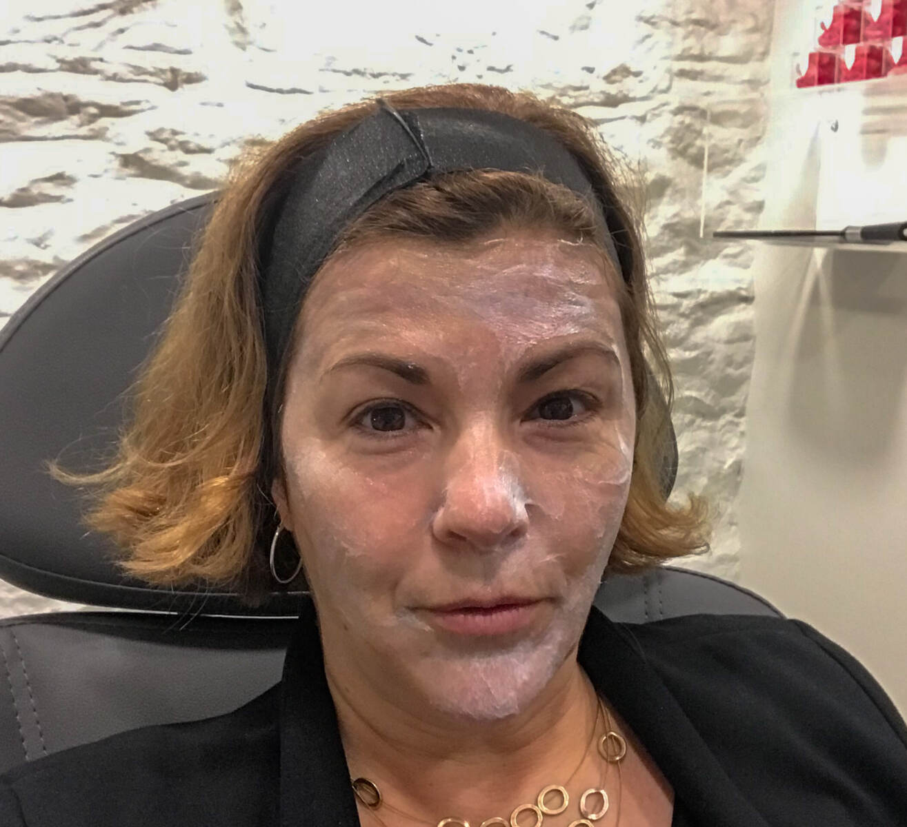 What’s behind the new trend of “stem cell” microneedling? — WHYY