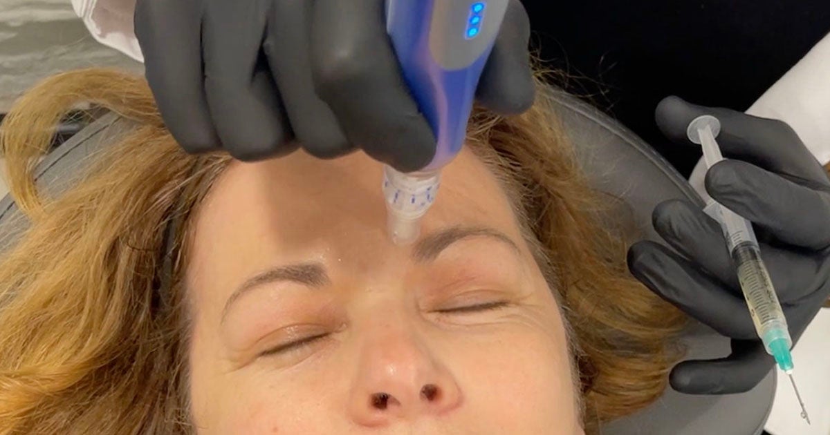 What’s behind the new trend of “stem cell” microneedling? — WHYY